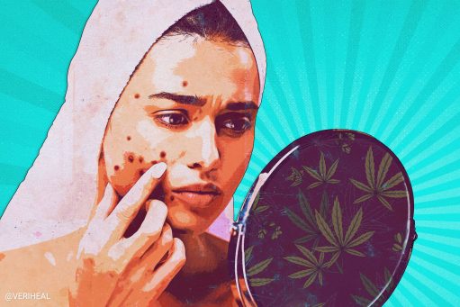 Can You Alleviate Pesky Acne with Medical Marijuana?