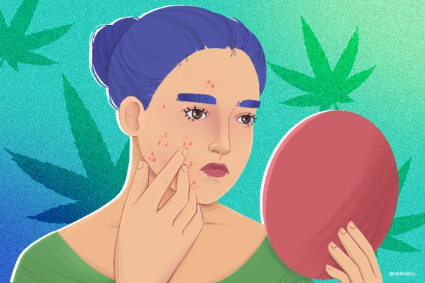 How Cannabis Can Help Your Acne | Medical Marijuana for Acne